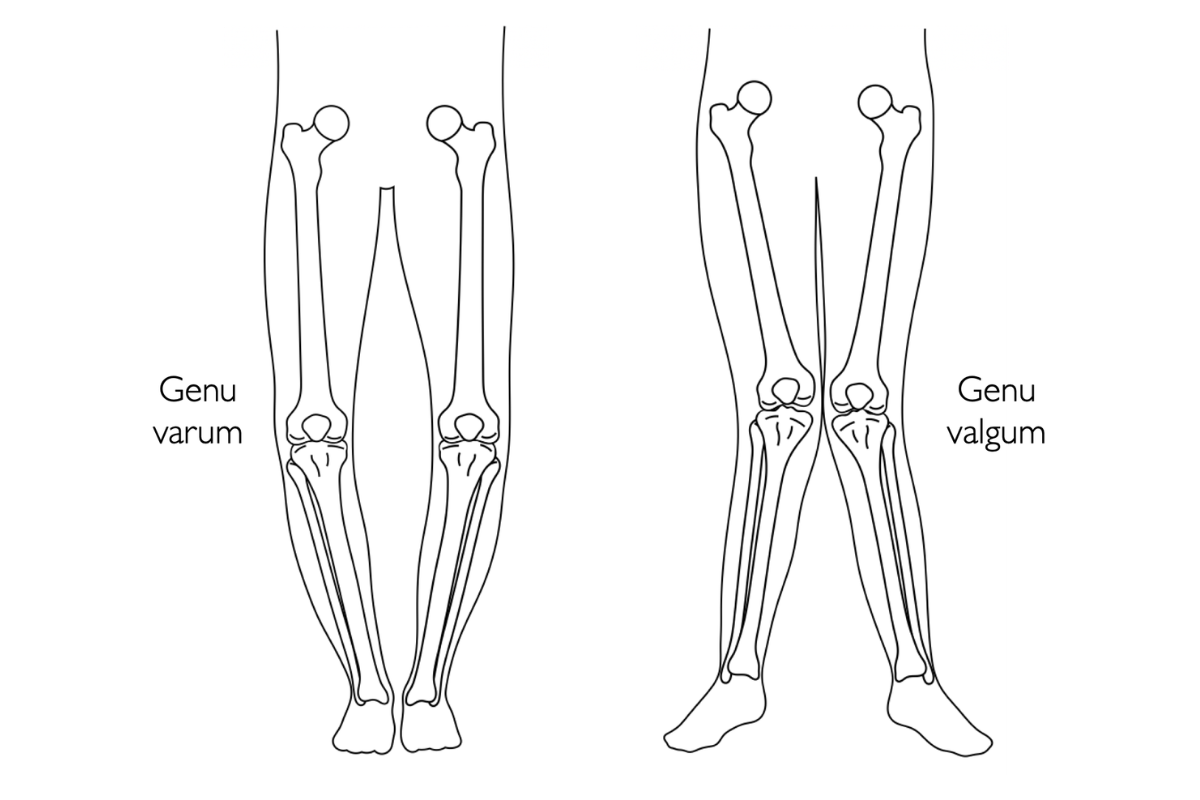 Genu varum (bowlegs) and valgum (knock-knees)